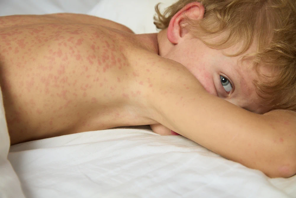 Viral Rash Toddler