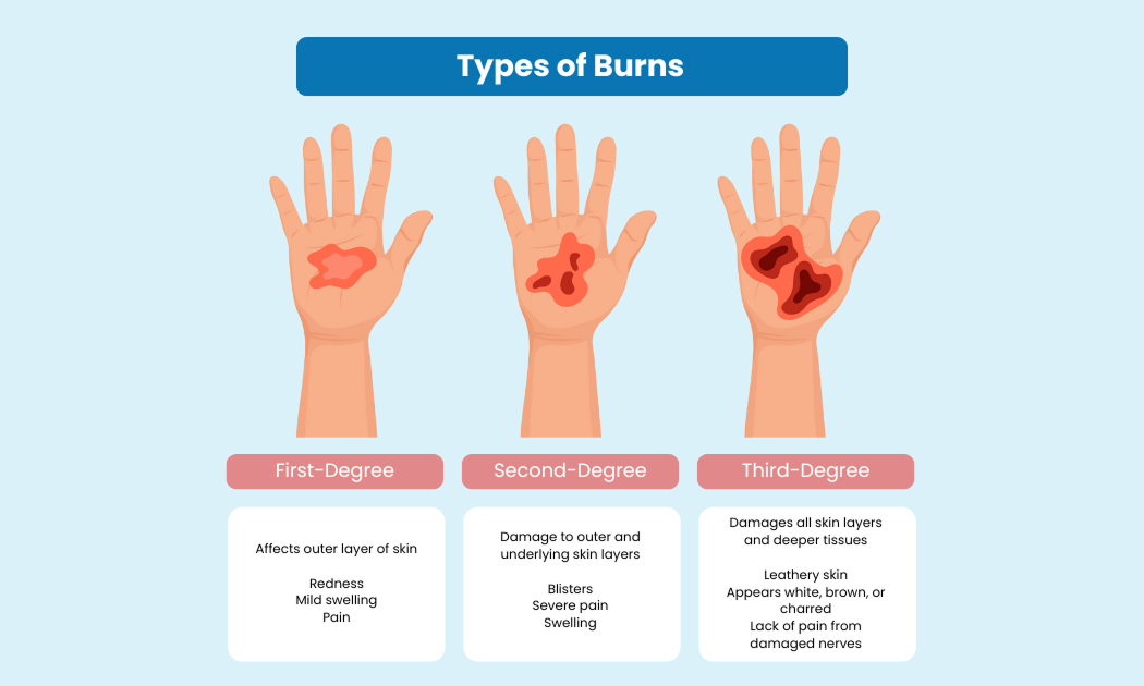 Emergency Burn Care Treatment | Complete Care